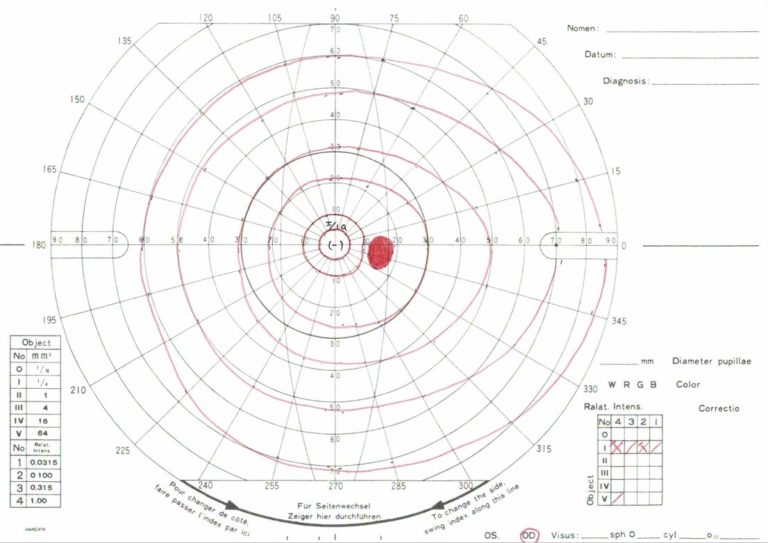 Goldmann視野計（GP）【入門編】～上達するための3つのポイント～
